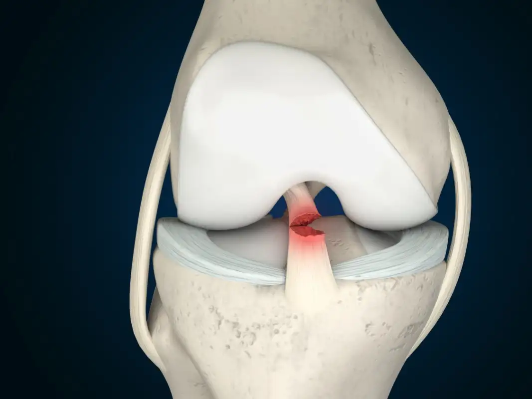 11 ACL Facts 11 Anterior Cruciate Ligament Fast Facts