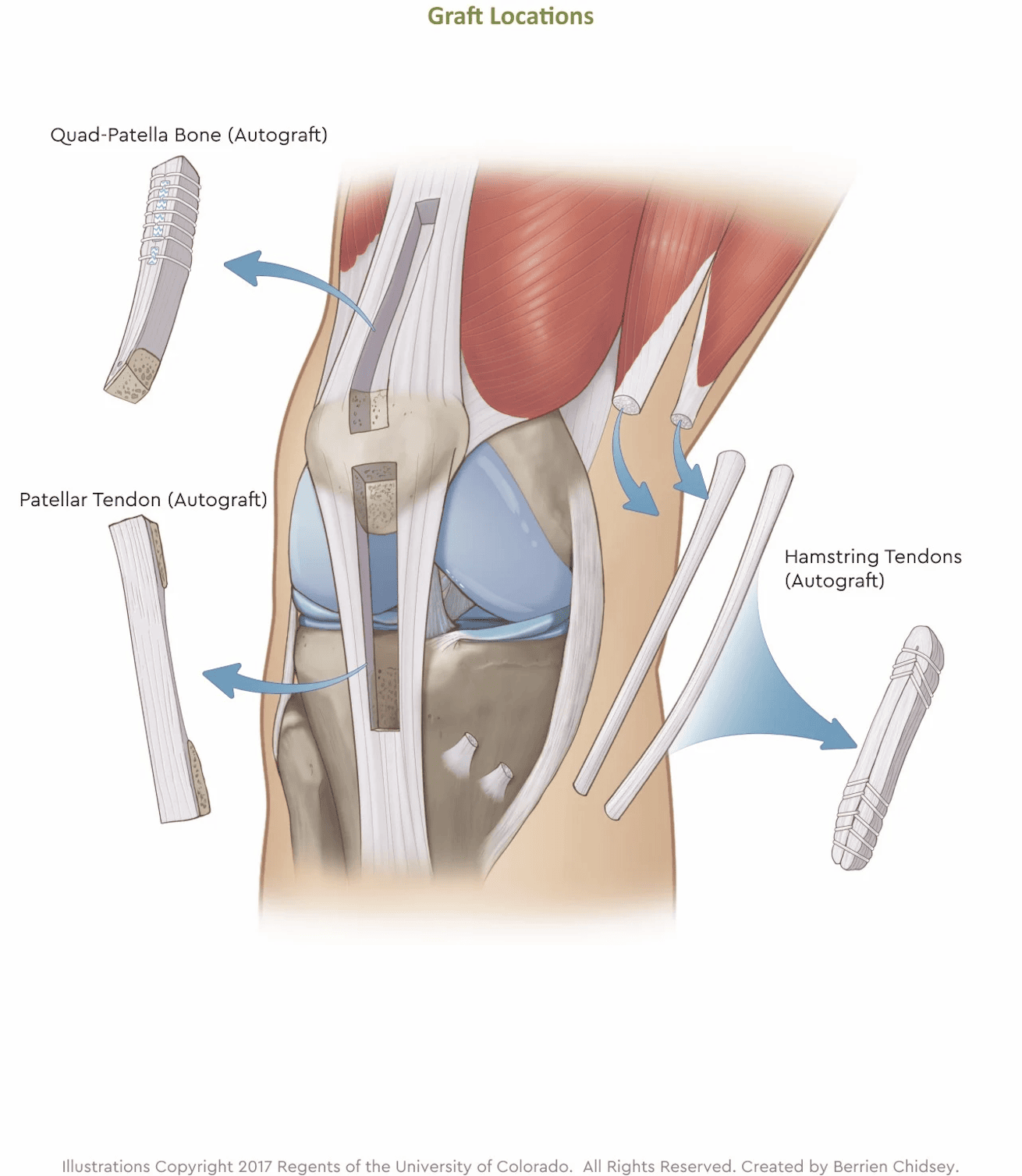 ACL Reconstruction Surgery Complete Guide│Injury To Recovery
