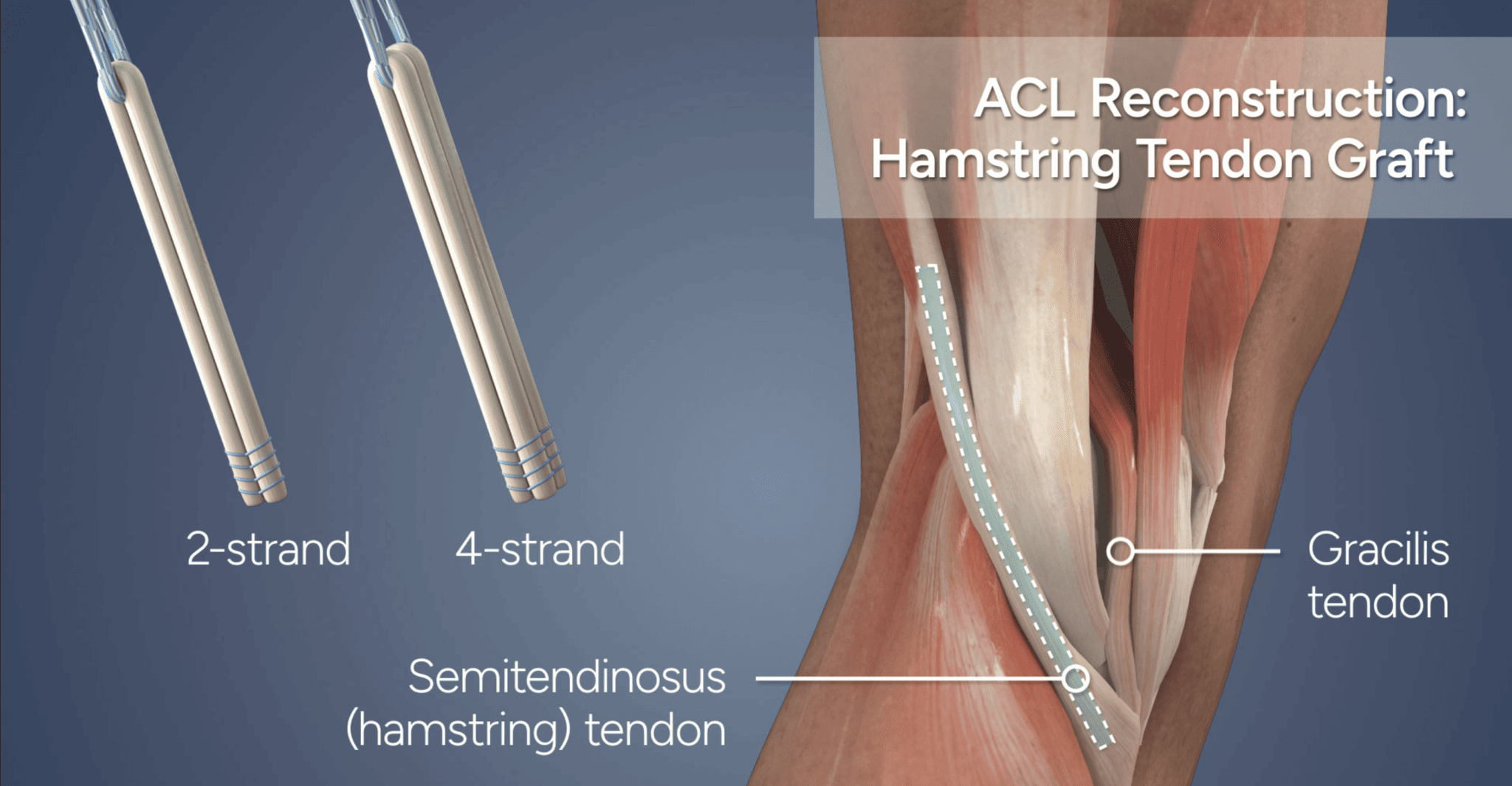ACL Reconstruction Surgery Complete Guide│Injury To Recovery