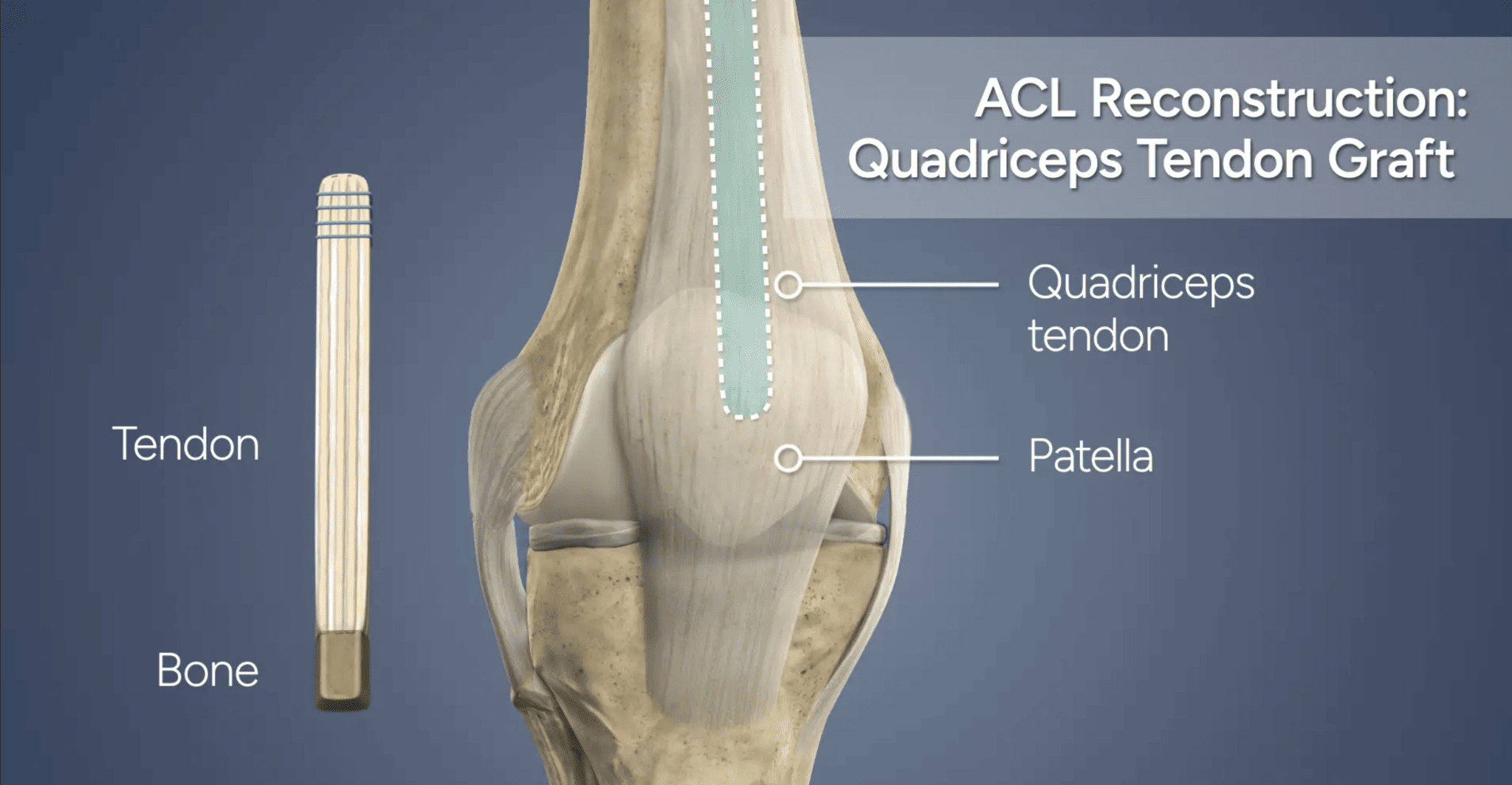 ACL Reconstruction Surgery Complete Guide│Injury To Recovery