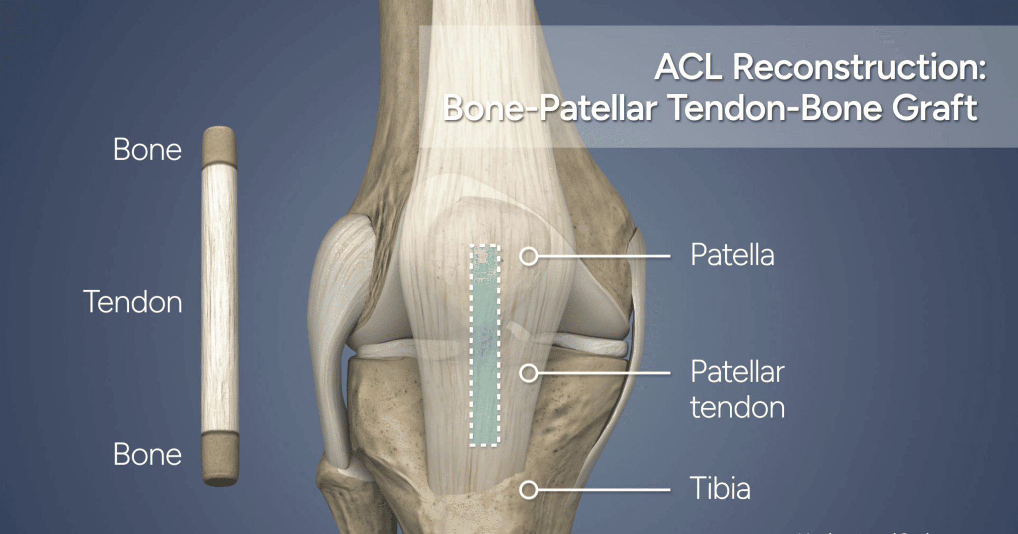 ACL Reconstruction Surgery Complete Guide│Injury To Recovery