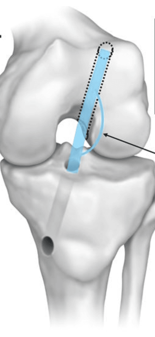 ACL Tunnel Surgery Techniques: The Diagnostics Revolution