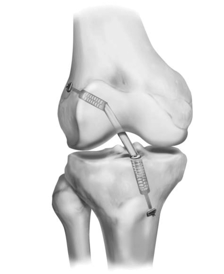 ACL Reconstruction Surgery Complete Guide│Injury To Recovery