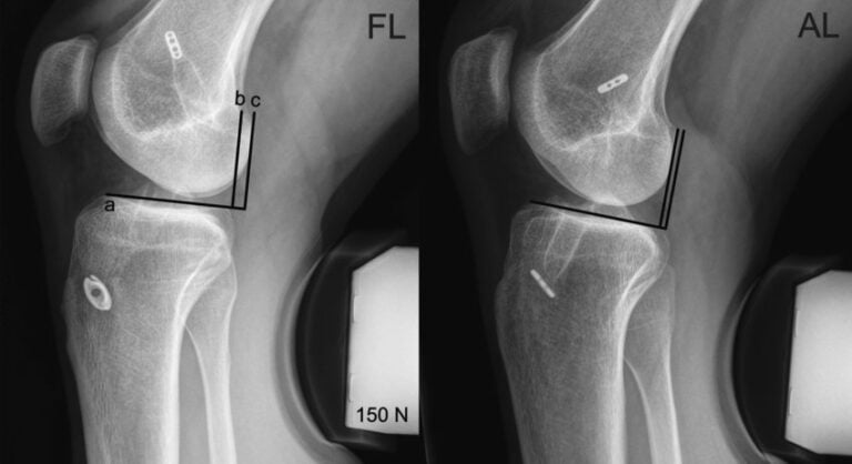 Top 6 ACL Diagnostic Tests Explained: Unlocking Knee Stability